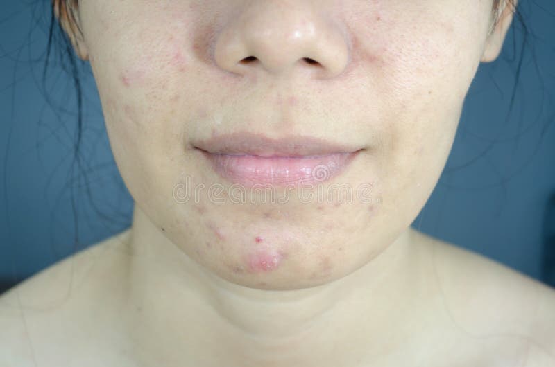 Severe acne. stock photo. Image of smooth, health, care - 59957386
