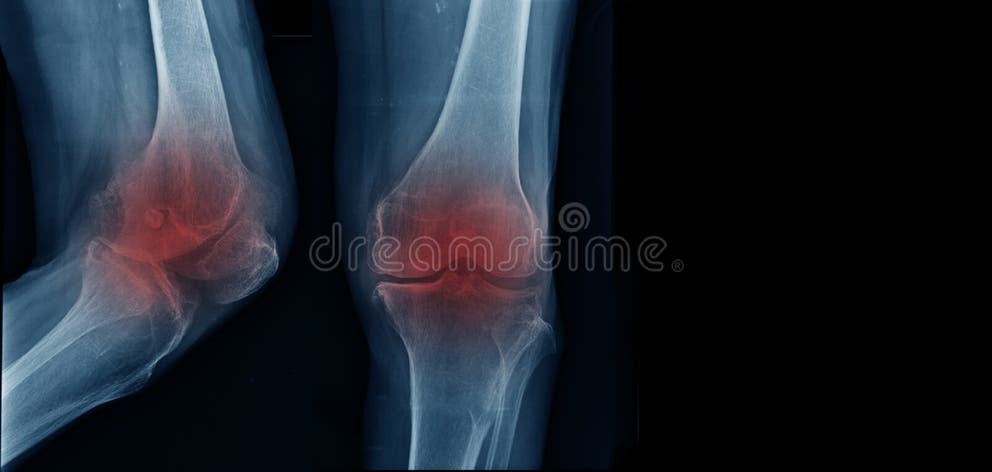 OA knee x-ray image stock photo. Image of osteopathy - 123023072