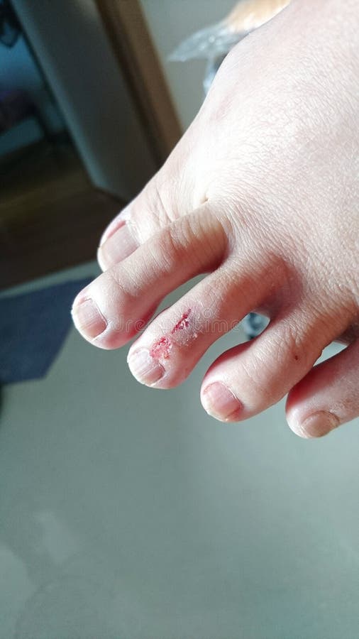 Severely injured toe stock photo. Image of blood, crushed - 89711228