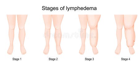 Severity of Lower Extremity Lymphedema in Different Stages. Stock ...