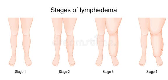 Severity of Lower Extremity Lymphedema in Different Stages. Stock ...