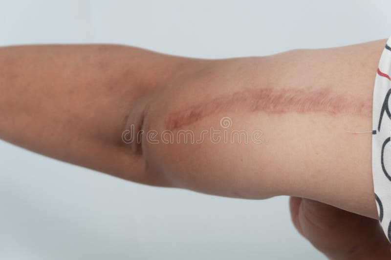 Sewing Scar or Surgery Scar on Arm Stock Photo - Image of dermatology ...