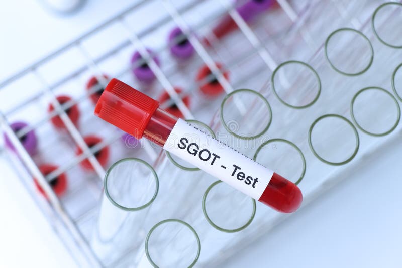 SGOT Test To Look for Abnormalities from Blood Stock Image - Image of ...