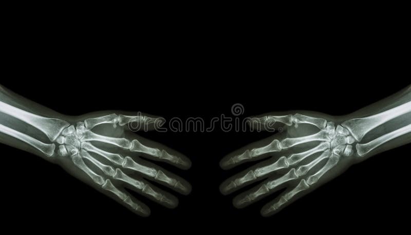 Shake Hands . X-ray Normal Human Hands ( Blank Area at Upper Side ...