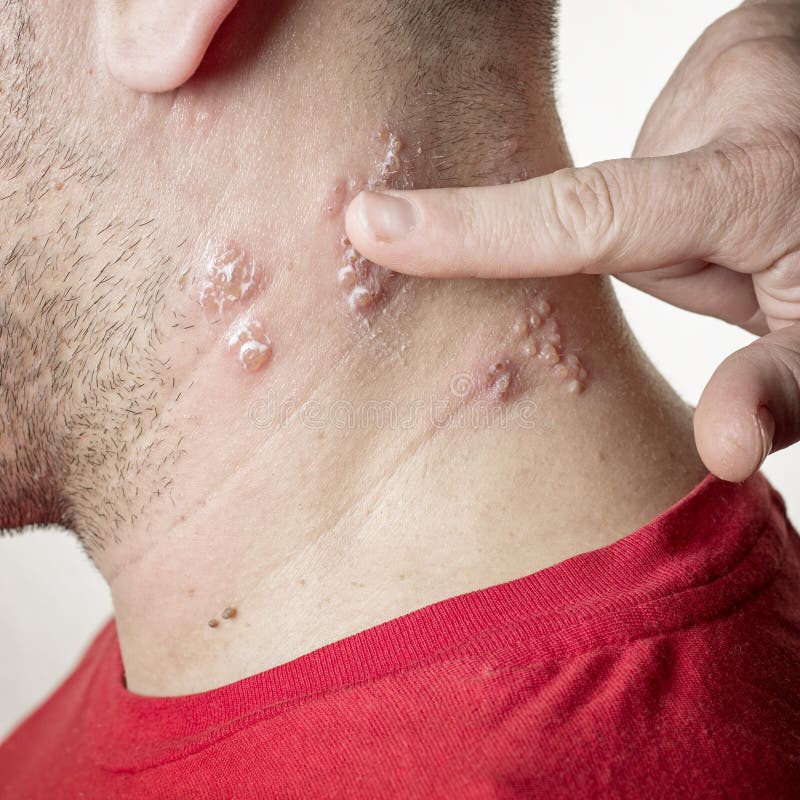 Shingles virus stock photo. Image of wound, escape, medical - 30355230