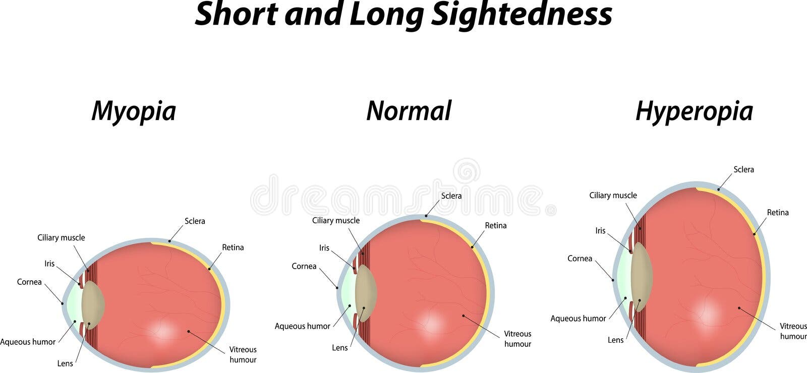 Myopia, Hyperopia and Astigmatism. Common Vision Disorders and Its ...