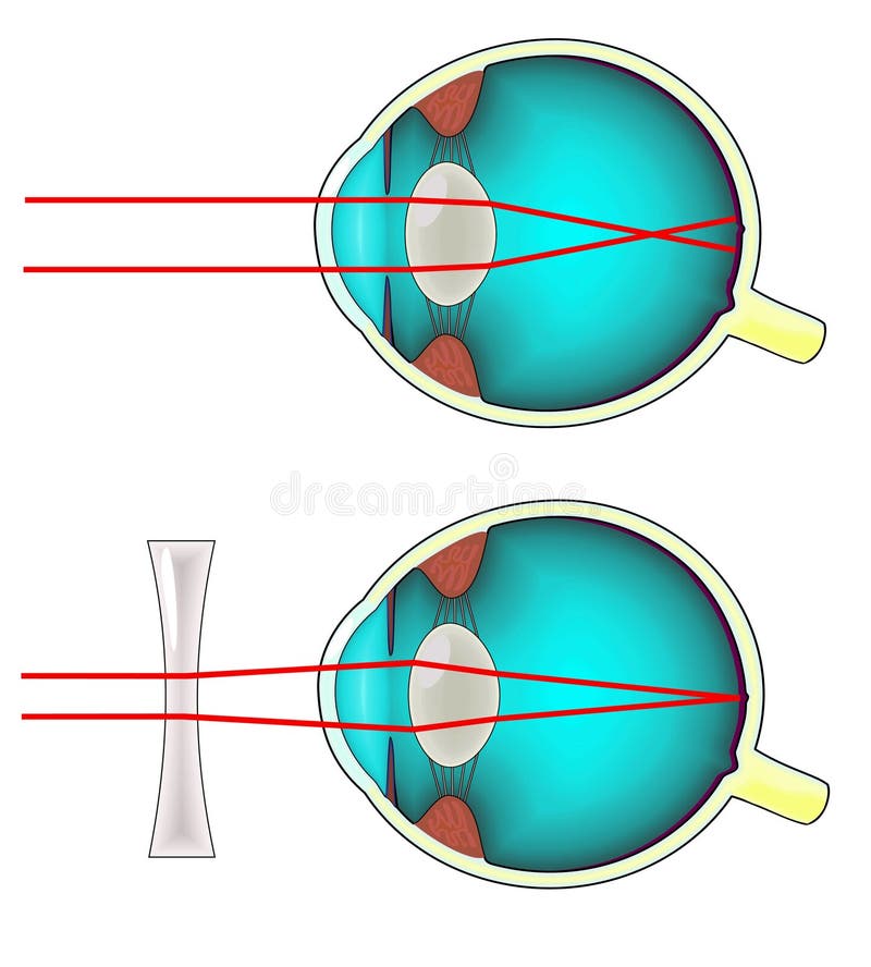 Shortsighted eye diagram stock illustration. Illustration of short ...