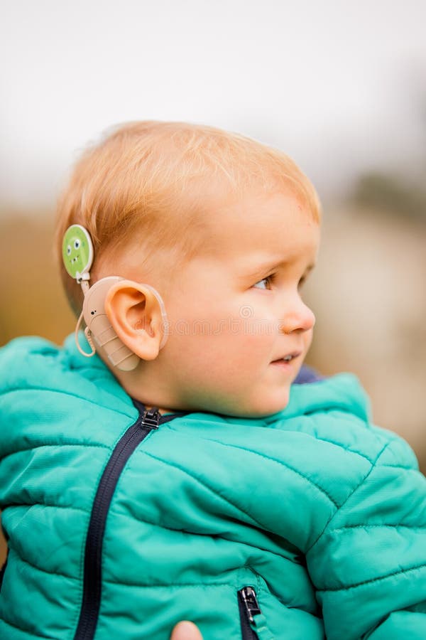 Shot of a Baby Looking with Cochlear Implants Stock Photo - Image of ...