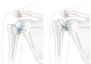 Shoulder Arthroplasty. Shoulder Replacement. Illustration Stock ...
