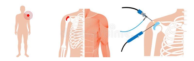Shoulder Arthroscopy Poster Stock Vector - Illustration of cuff, pain ...