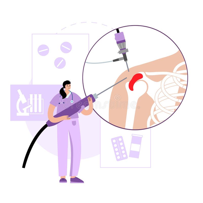 Shoulder Arthroscopy Poster Stock Vector - Illustration of inflamed ...