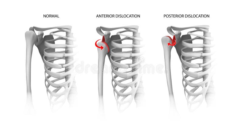 Shoulder Dislocation Options Stock Illustration - Illustration of ...