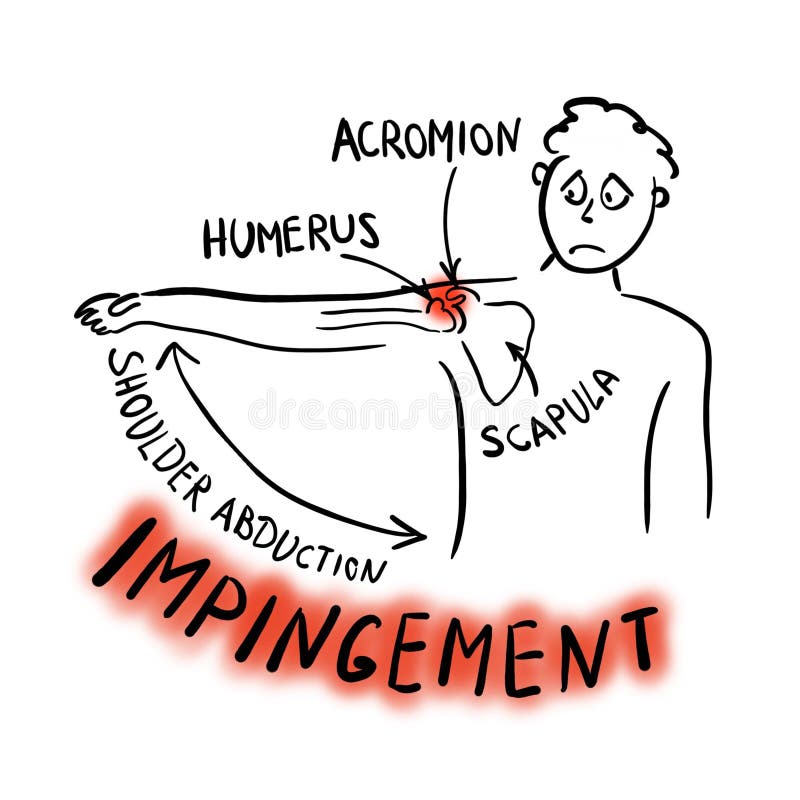 Shoulder Impingement Stock Illustrations – 159 Shoulder Impingement ... Shoulder Impingement Stock Illustrations – 159 Shoulder Impingement ...