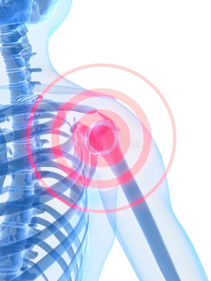 Shoulder inflammation stock illustration. Illustration of ribs - 3387806