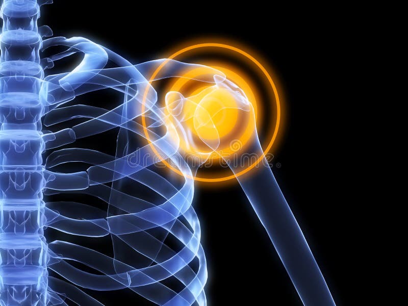 Shoulder inflammation stock illustration. Illustration of skeletal ...