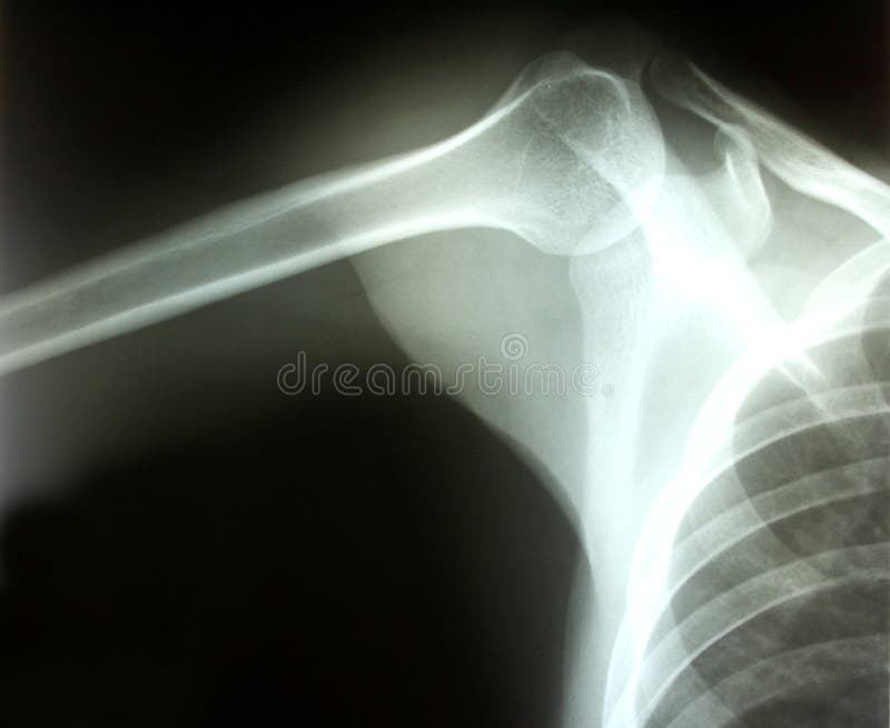 Shoulder joint x-ray stock image. Image of anterior, health - 19159715