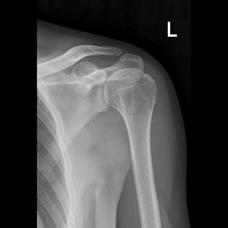 Shoulder Joint X-ray Image AP View Stock Image - Image of clevicle ...