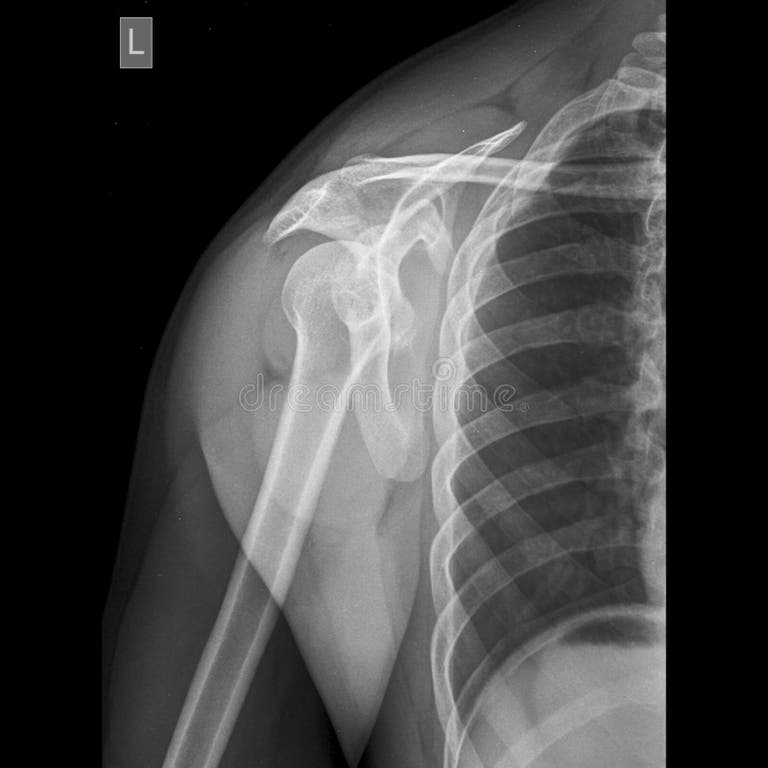 Shoulder Joint X-ray Image Lateral View Stock Photo - Image of imaging ...