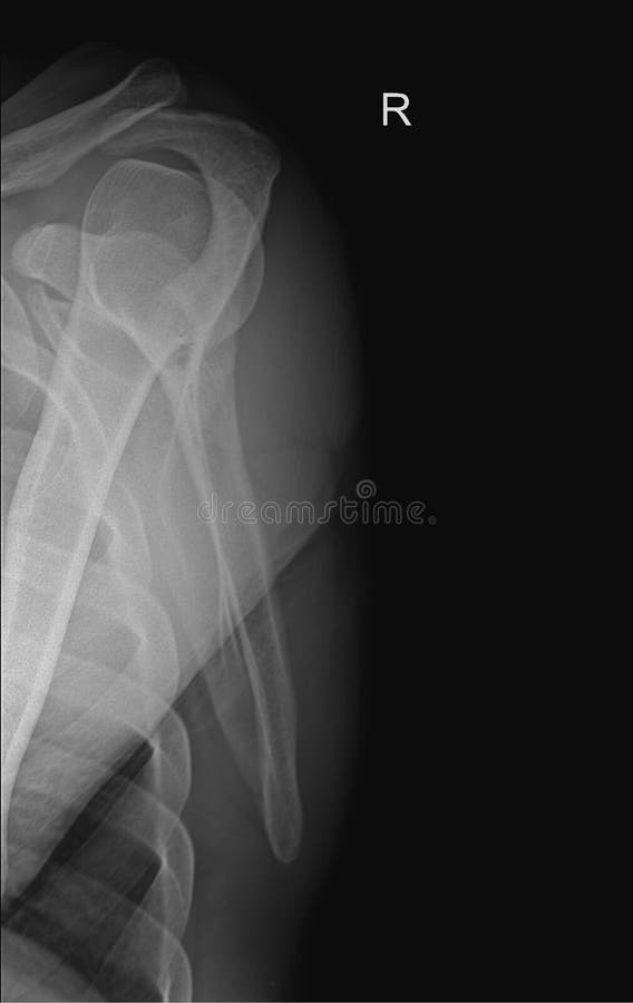 Scapula Y Stock Photos - Free & Royalty-Free Stock Photos from Dreamstime