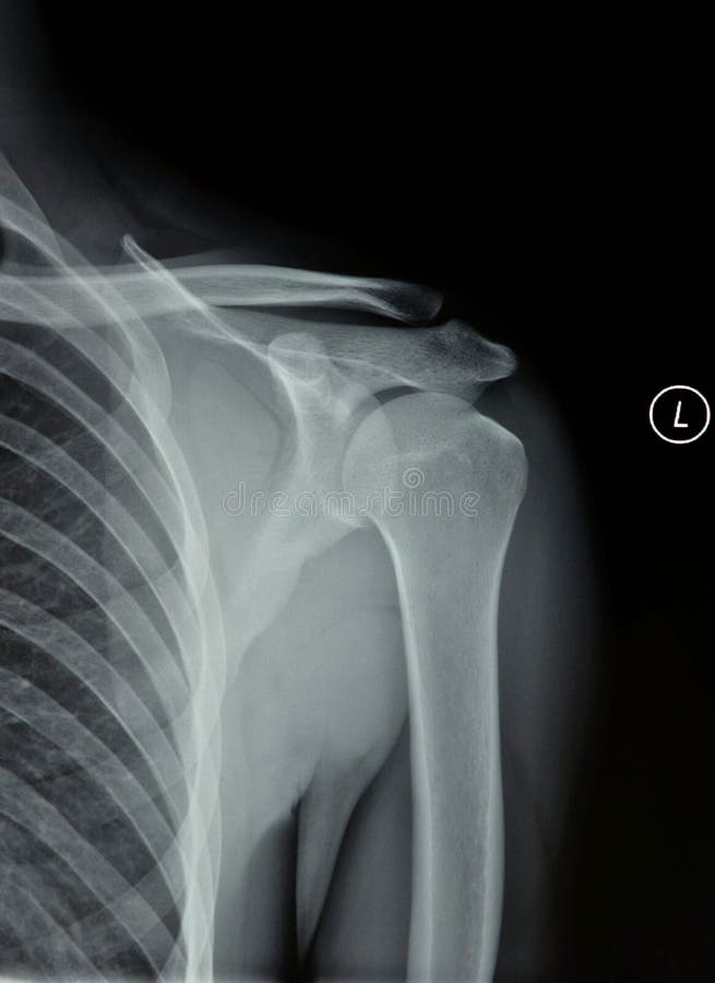 Shoulder joint X-ray, Shoulder joint X-ray photos, the