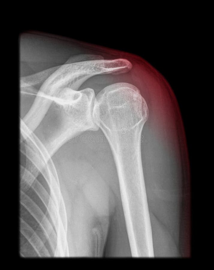 Sport Injury- Plain Film X-ray, Radiography of Dislocated Shoulder ...