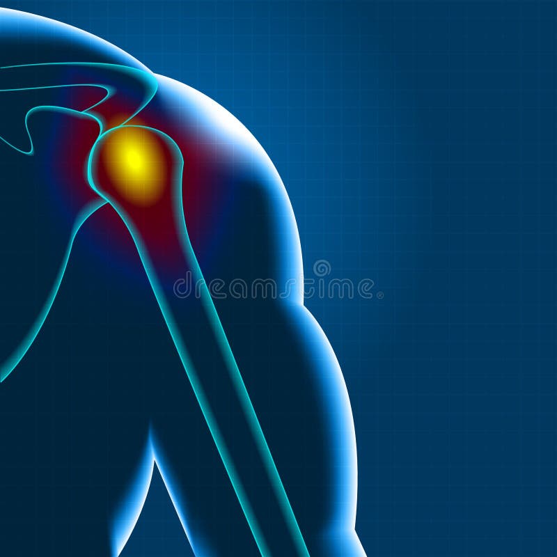 Shoulder pain stock vector. Illustration of health, biology - 45254212