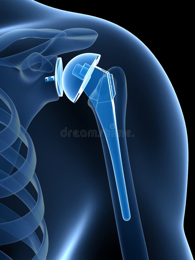 X-ray shoulder stock illustration. Illustration of torso - 4145325