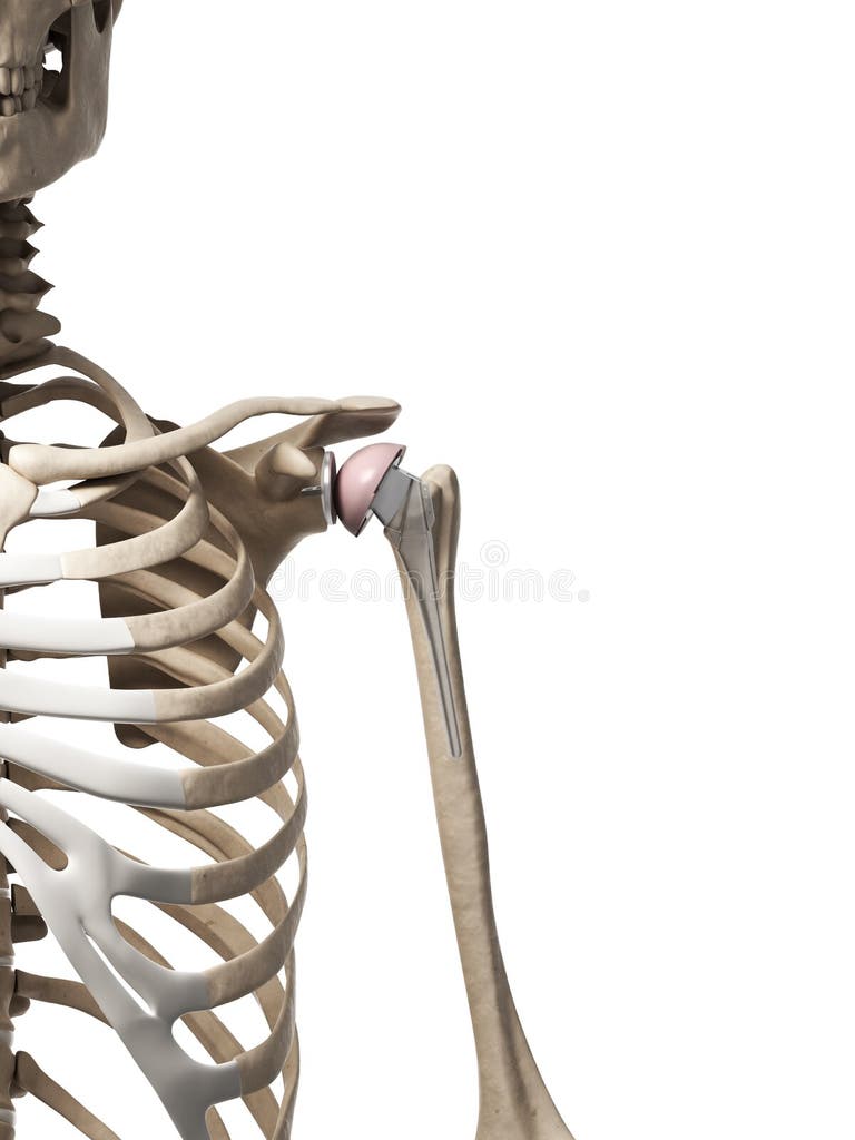 Shoulder Replacement Stock Illustrations – 193 Shoulder Replacement ...