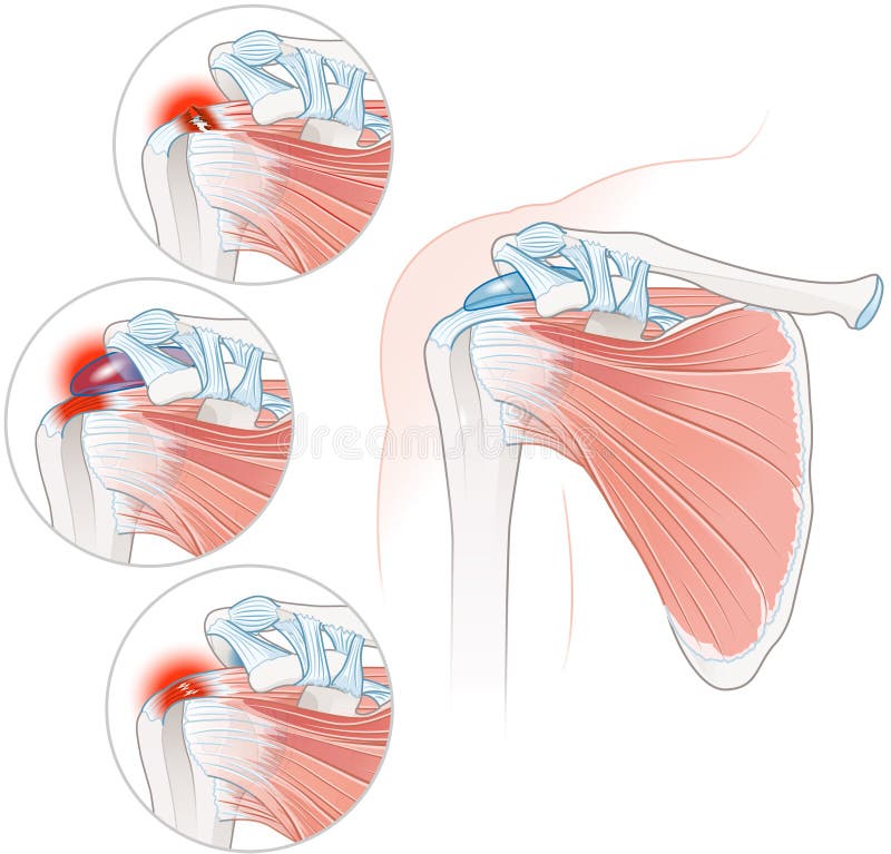 Rotator Cuff Bursitis Shoulder Illustration. Labeled Stock Illustration ...