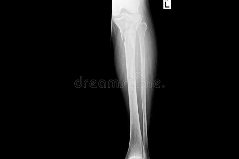 Show Image of Tibia and Fibula Left Lateral Stock Photo - Image of ...
