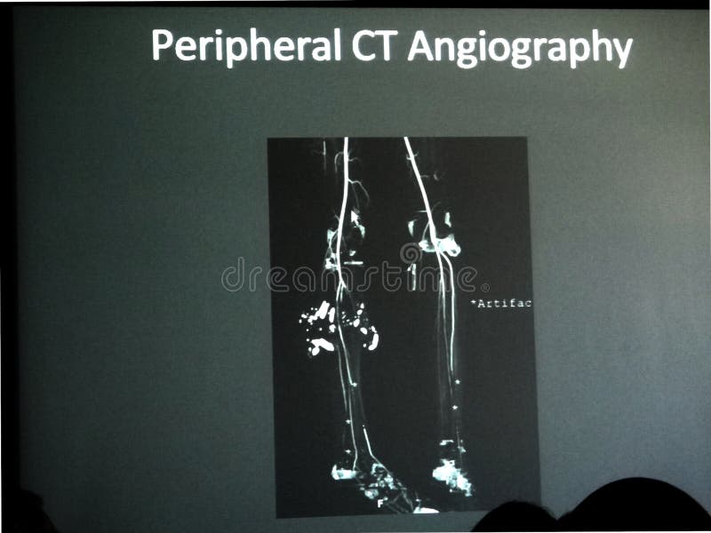 Shrapnel Arterial Injuries from Hamas Rocket Explosions Stock Photo ...