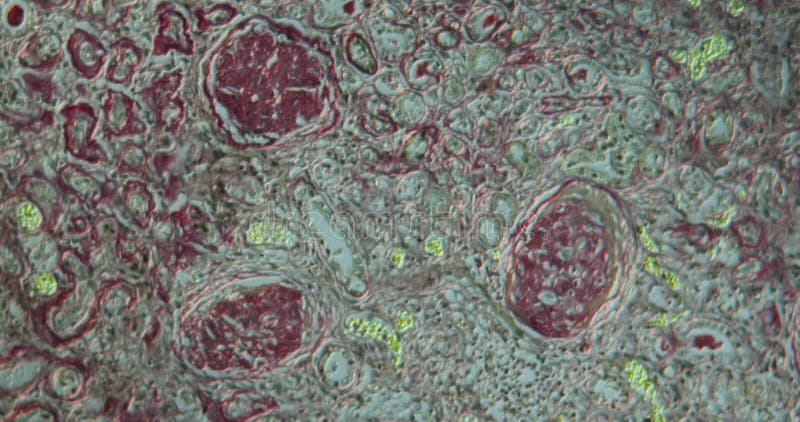 Shrinkage kidney disease stock footage. Video of kidney - 196556970