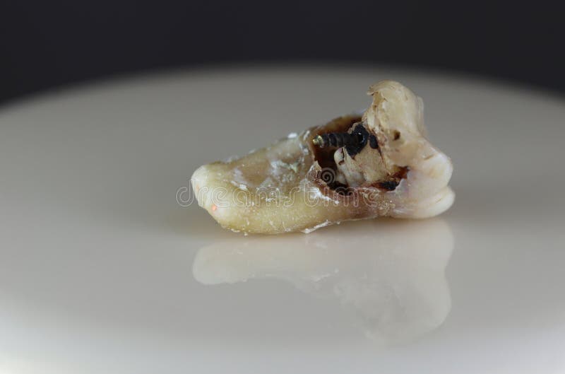 A Sick, Damaged Human Tooth Stock Image - Image of human, disease ...