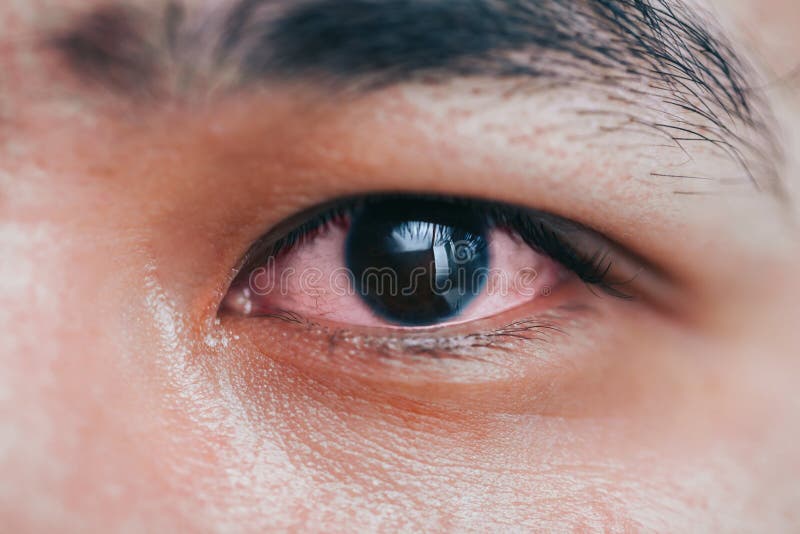Conjunctivitis, Tired Eyes, Red Eyes, Eye Disease Stock Photo - Image ...