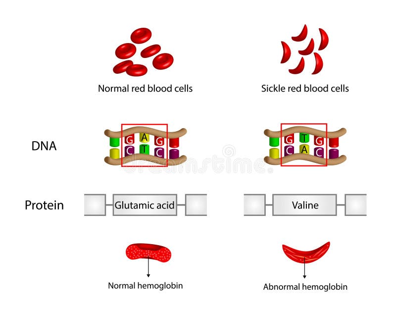 Sickle Cell Anemia, Disease. Normal and Sickled Red Blood Cells. Stock ...