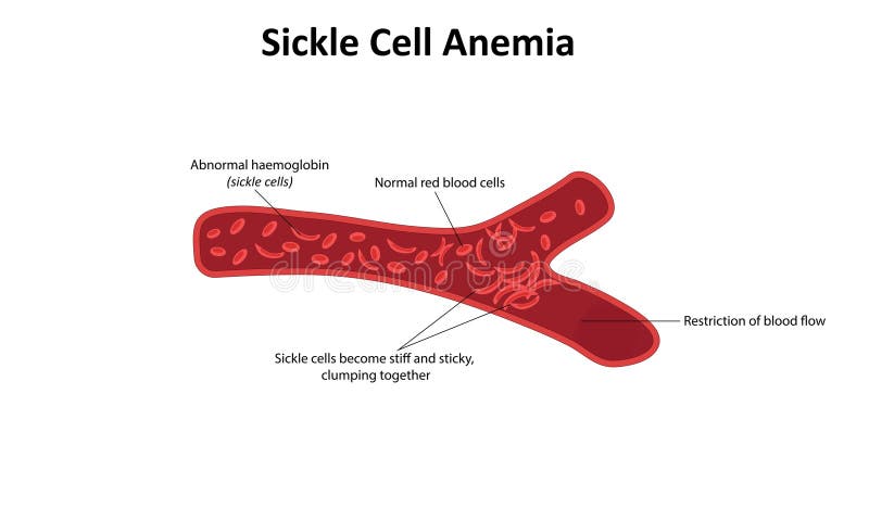 Sickle Cell Anemia Stock Illustrations – 557 Sickle Cell Anemia Stock ...