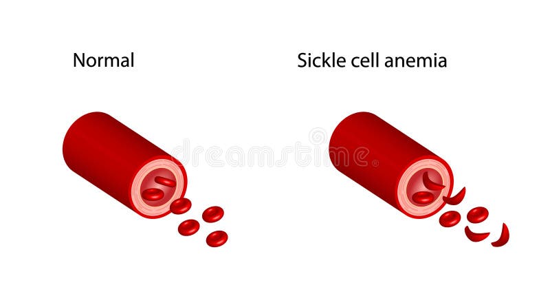 Sickle Cell Haemoglobin Stock Illustrations – 52 Sickle Cell ...