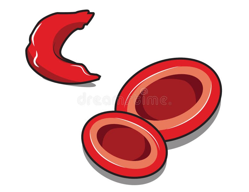 Sickle cell anemia stock vector. Illustration of sick - 95854211
