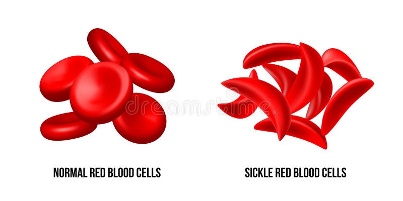 Sickle Cell Disease. the Difference of Normal Red Blood Cell and Sickle ...