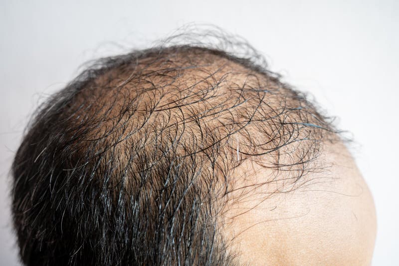 Side View of Baldness Men S Head with Thin Hair on His Top and Forehead ...