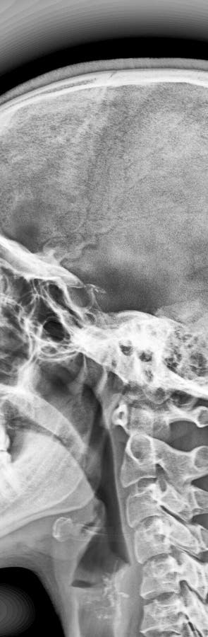 Side View of Human Brain X-ray Medical Scan Stock Photo - Image of blue ...