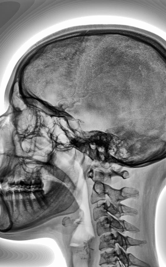 Side View of Human Brain X-ray Medical Scan Stock Image - Image of ...
