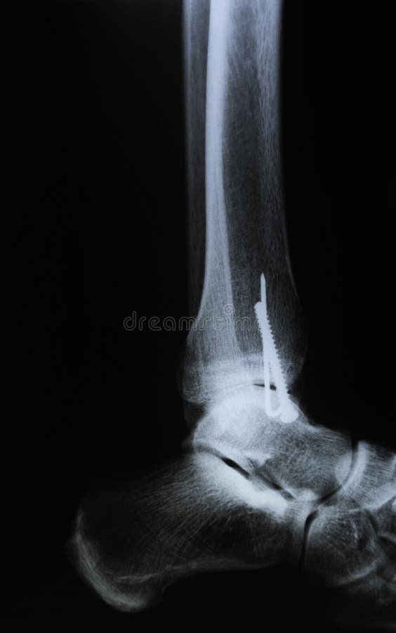 Side View of X-RAY Scan. Human Leg with Metal after the Surgery. Stock ...