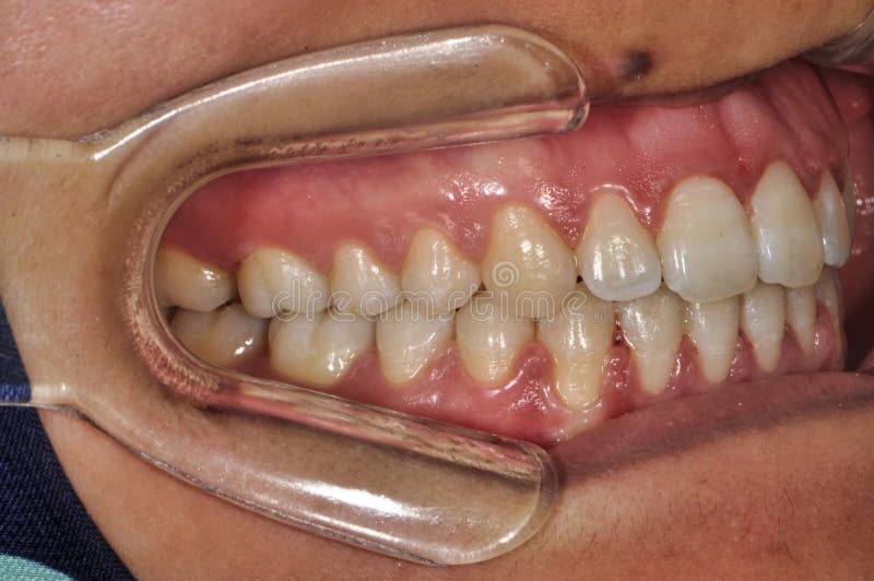 Side View of Teeth with Retractor Stock Photo - Image of dentist ...