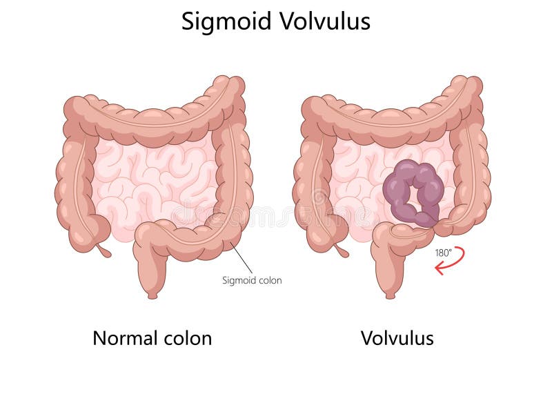 Sigmoid Volvulus and Normal Colon Diagram Medical Stock Vector - Illustration of system ...