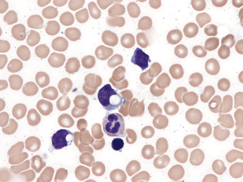 Signet Ring Lymphoma. Bone Marrow Cytology. Stock Photo - Image of ...