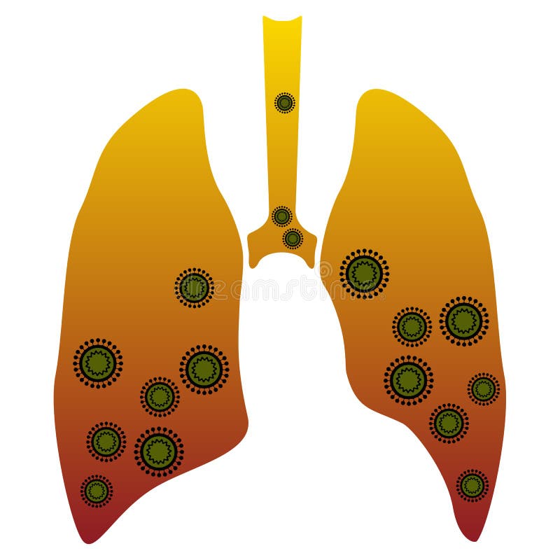 Silhouette of Human Lungs with a Virus. Pneumonia Illustration Stock ...