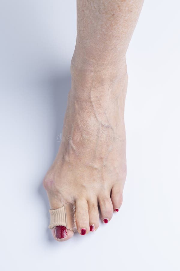 Thumb Index Finger Swollen Stock Photos - Free & Royalty-Free Stock ...