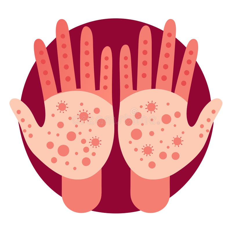 Hands with Monkeypox Rash, Infectious Disease Concept Stock ...