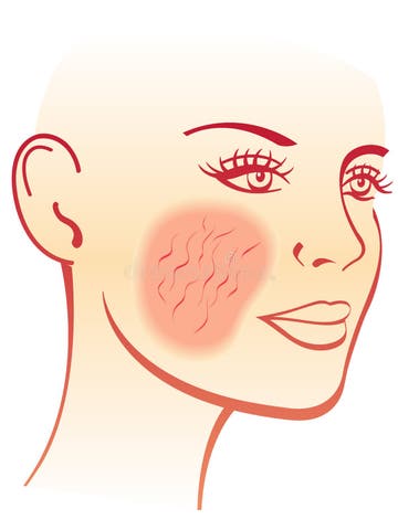 Rosacea Stock Illustrations – 741 Rosacea Stock Illustrations, Vectors ...